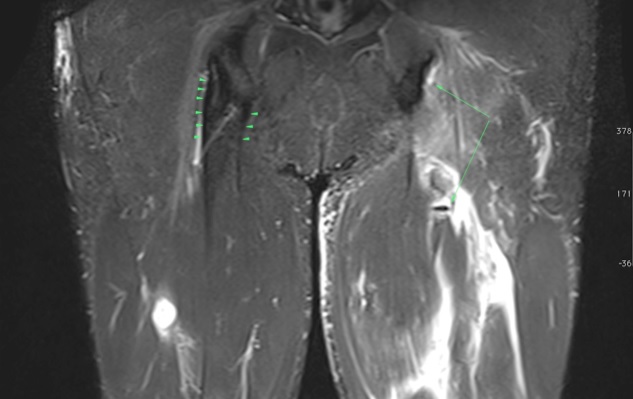 Torn Hamstring X Ray